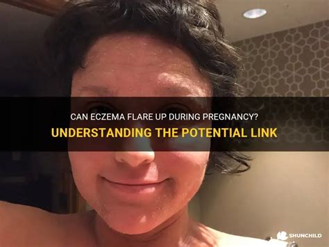 Can Eczema Flare Up During Pregnancy Understanding The Potential Link