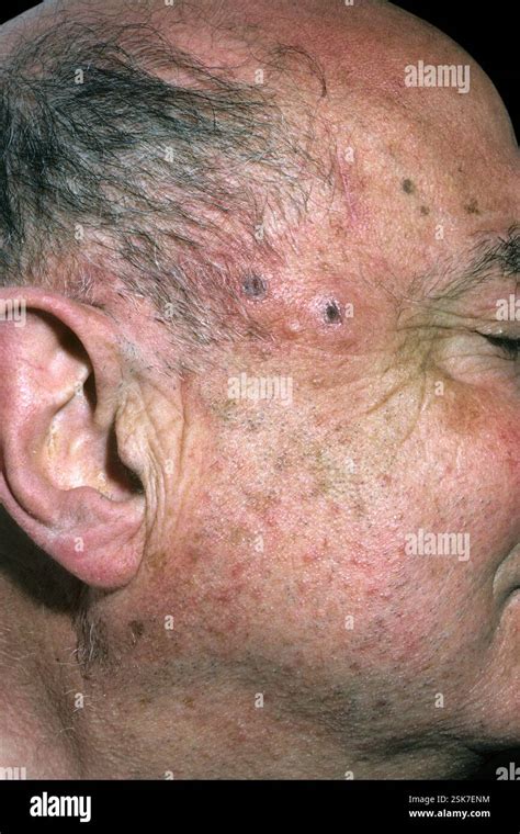 Temporal Arteritis Skin Lesions Around A Prominent Artery With