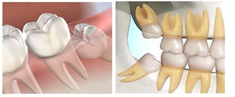 Effective Tooth Impaction Treatment In Delhi Expert Dental Care For