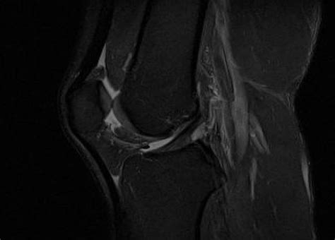 Francescoacl X Ray · Datasets At Hugging Face