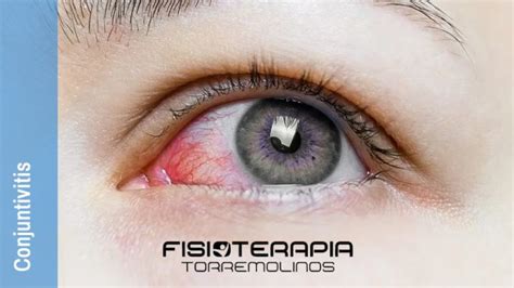 Ojo Rojo Y Conjuntivitis Causas Síntomas Y Prevención
