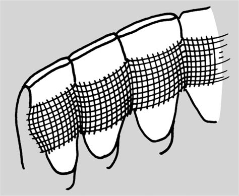 Perfect Splint System Hager And Werken