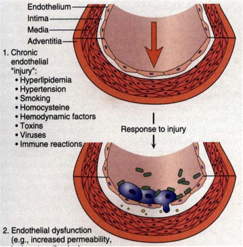 Atherosclerosis Flashcards Quizlet