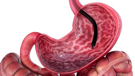 GASTROPLASTIA ENDOSCOPICA – Nova técnica de Gastroplastia