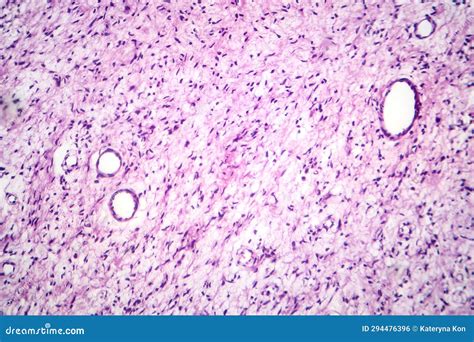 A Neurofibroma Tissue Sample In Neurofibromatosis Genetic Disease