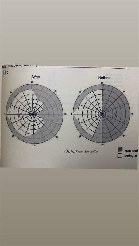 Visual Field Expansion In Homonymous Hemianopia By Using Fresnel Prism My Experience Using