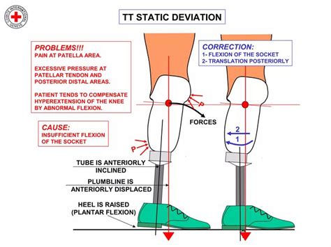 Transtibial Static Alignment Alignment Orthotics And Prosthetics
