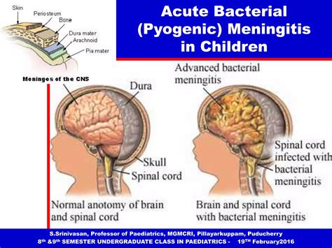 Acute Bacterial Pyogenic Meningitis Dr S Srinivasan Professor Of