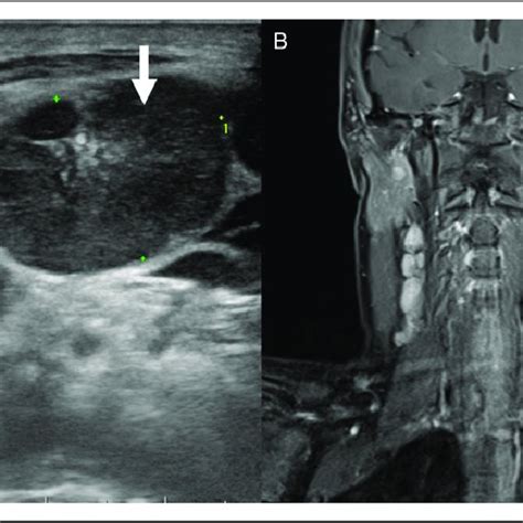 A The Neck Sonogram Of Case 1 Shows Multiple Conglomerated Lymph