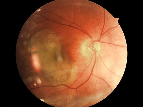 Digital Retinal Imaging F L Wangler Opticians