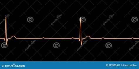 Atrioventricular Nodal Reentry Tachycardia Conduction System Royalty Free Stock Image