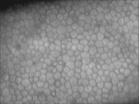 Specular Microscopy Clinical Tree
