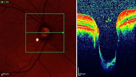 An Oct Normal Od Subject Left The Onh Cup And Its Surroundings The Download Scientific