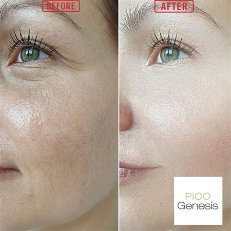 Pico Genesis And Pico Fx Can Help Lighten Your Complexion While Stimulating Collagen Growth