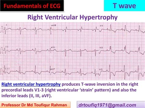 Approach To A Patient With T Wave Abnormality In Ecg Ppsx Heart And Cardiovascular Diseases