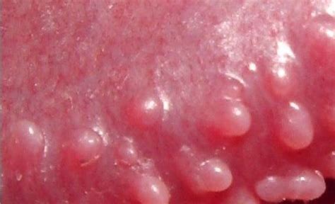 What Ive Got White Bumps On My Penis Pearly Penile Papules Removal