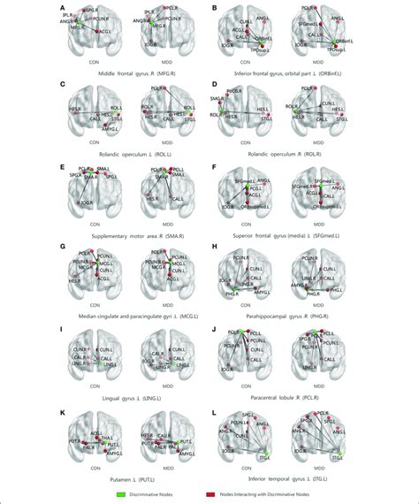 connected patterns of abnormal brain regions in hyper network
