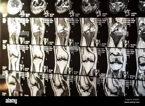 Magnetic Resonance Imaging Of Human Knee Joint For Medical Diagnosis