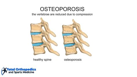 How Do I Strengthen My Back After A Compression Fracture Total Ortho Sports Medicine