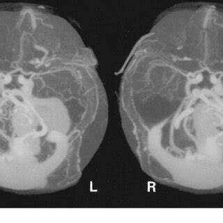 Pdf Unusual Manifestation Of A Vein Of Galen Malformation Value Of