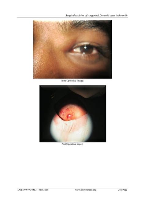 Surgical Excision Of Congenital Dermoid Cysts In The Orbit Pdf