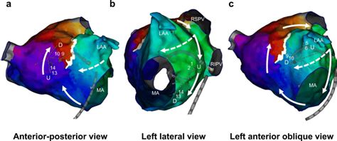 Representative Three Dimensional Activation Maps Of A Dual Loop Reentry Download Scientific