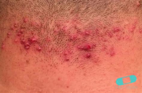 Folliculitis Barbers Itch Online Dermatology