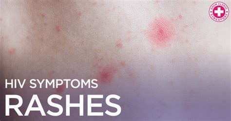 HIV Rash Singapore HIV Rash Shim Clinic