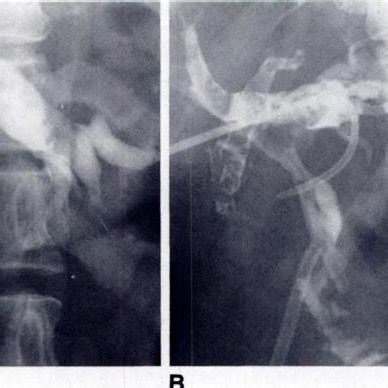 PDF Oriental Cholangiohepatitis Diagnostic Imaging And Interventional Management