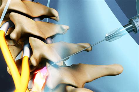 Selective Nerve Root Block Trinity Pain Management