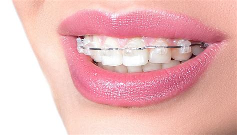 Braces Care Scaling And Polishing Treatment Kong Dental Clinic