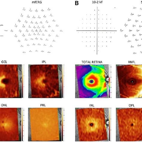10 2 Visual Field Pattern Deviation Plot Local Responses On Regular Download Scientific