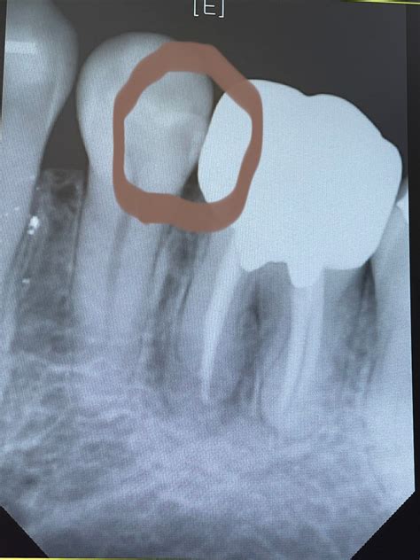 치아 썩은건가요 엑스레이 사진 지식in