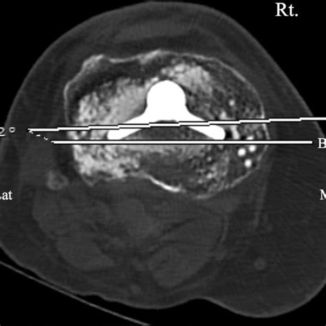 Method Tibial Component Rotation Is The Angle Between Tibial Download Scientific Diagram