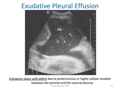 Ultrasonography Fundamentals In Critical Care Lung Ultrasound Pleural