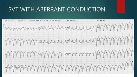 Differentials Of Arrythmias With Rbbb Morphology Pptx