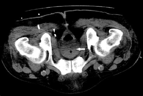 Pelvic Computed Tomography Reveals Marked Improvement Of The Prostatic Download Scientific