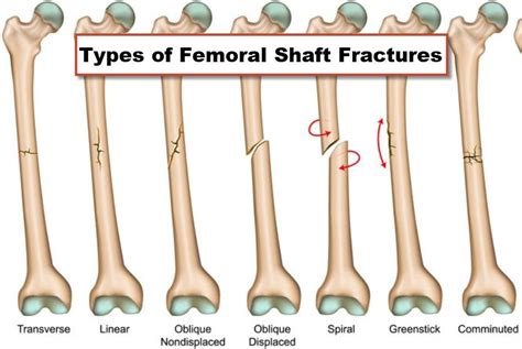 Fractures Types Symptoms Causes And Treatment Scientific 47 OFF