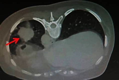 Ct Thorax Image Showing A Lesion In The Anterobasal Segment Of The Left Download Scientific