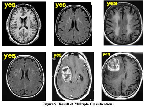 Real Time Multi Fractal Ensemble Analysis CNN Model For Optimizing Brain Tumor Classification