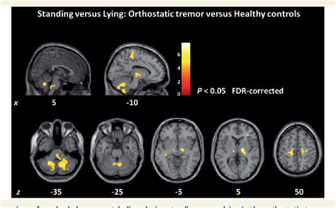 Primary Orthostatic Tremor Semantic Scholar