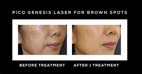 Pico Laser Before And After Photos