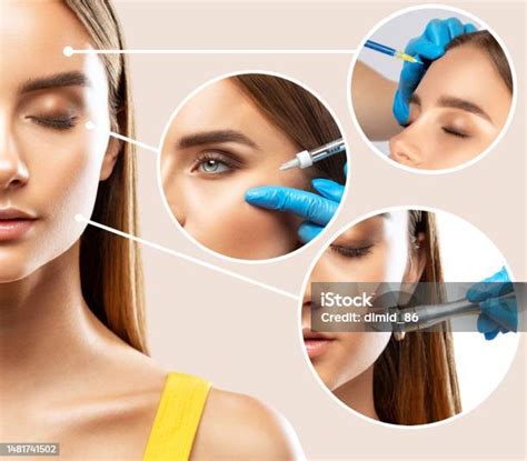 미세 박피술 절차와 주름 방지 주사의 콜라주는 아름다운 어린 소녀의 얼굴에 있습니다 미용실에서 여성 미용 주입에 대한 스톡 사진 및 기타 이미지 Istock