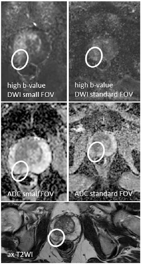 Figure 5 From How Does Pi Rads V2 1 Impact Patient Classification A Head To Head Comparison