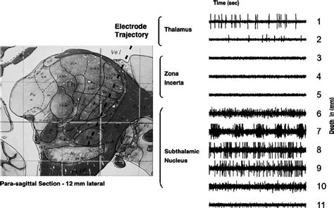Subthalamic Nucleus Stn Localization Reconstruction Of Single