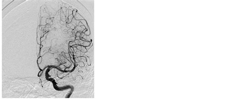 Successful Reperfusion With Tici 3 Recanalization Download