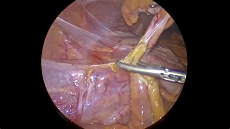 Laparoscopic Appendectomy By George Crawford Md Jandj Medtech