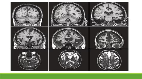 Neuroimaging In Dementia Pptx