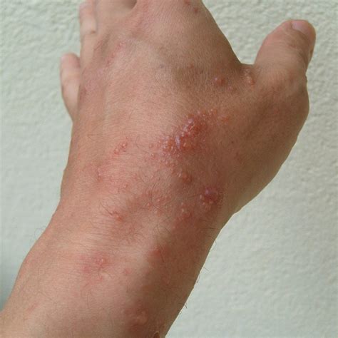 Poison Ivy Worse At Night Poison Ivy Poison Oak And Rashes What