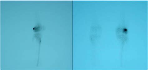 bone scan showing increased uptake download scientific diagram